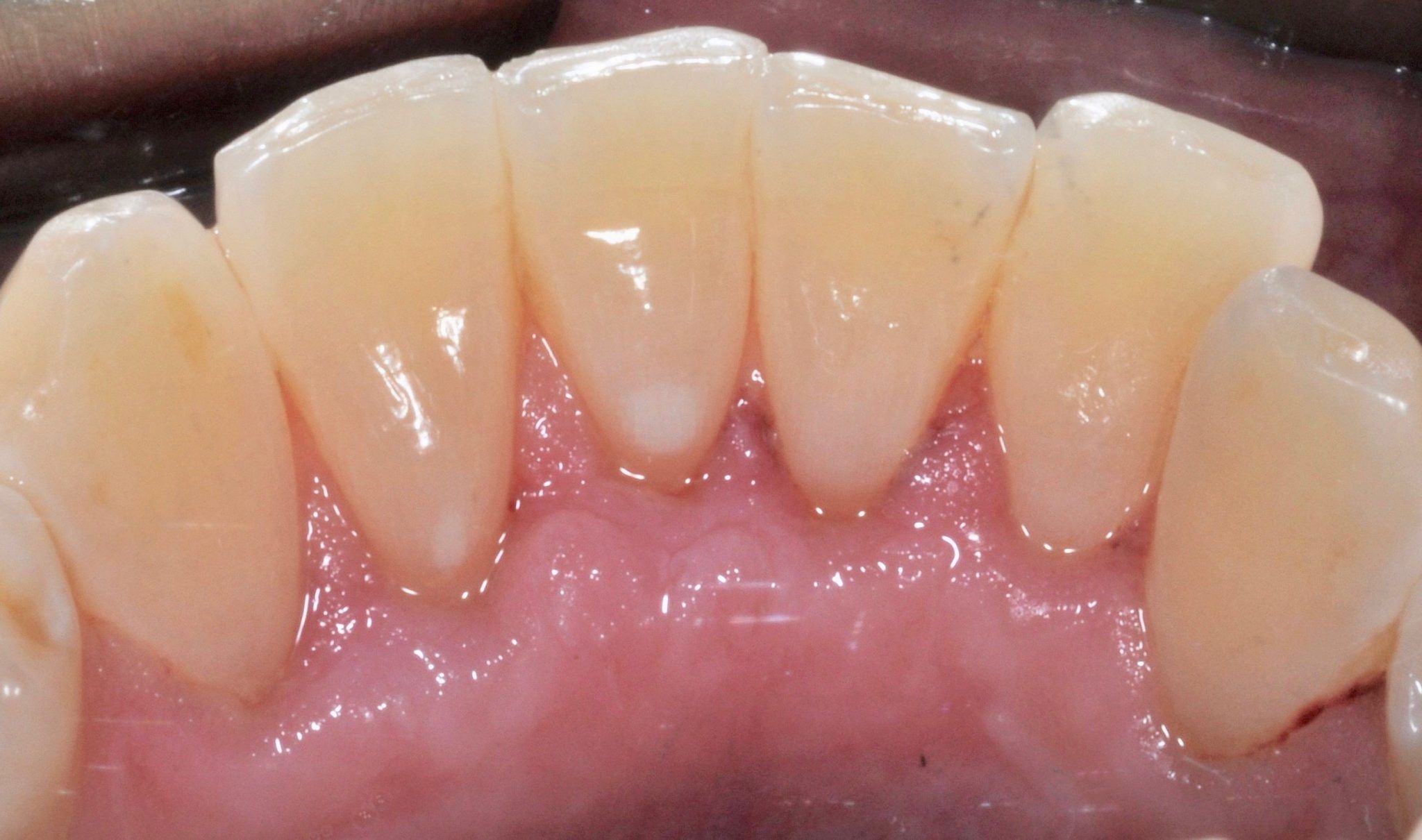 Gingival (Gum) Grafting – Dental Implants & Periodontics of CT