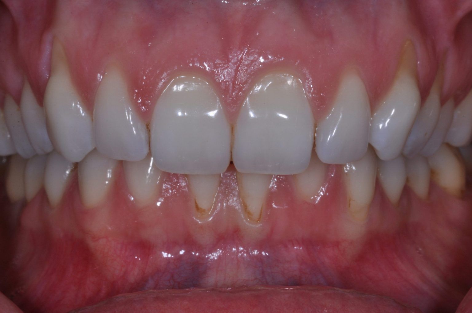 Gingival (Gum) Grafting – Dental Implants & Periodontics of CT