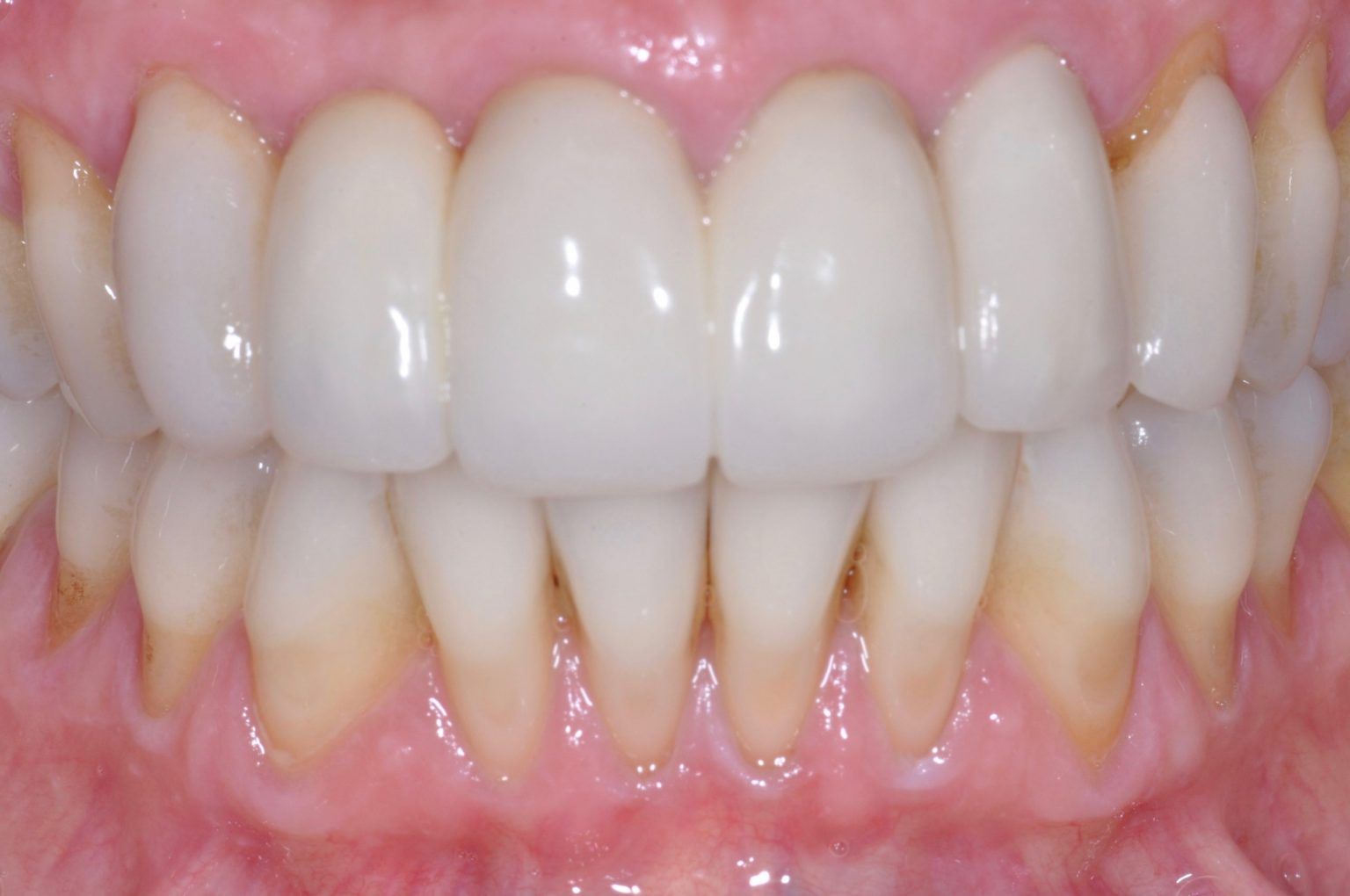 Gingival (Gum) Grafting – Dental Implants & Periodontics of CT