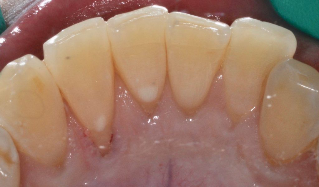 Gingival (Gum) Grafting – Dental Implants & Periodontics of CT