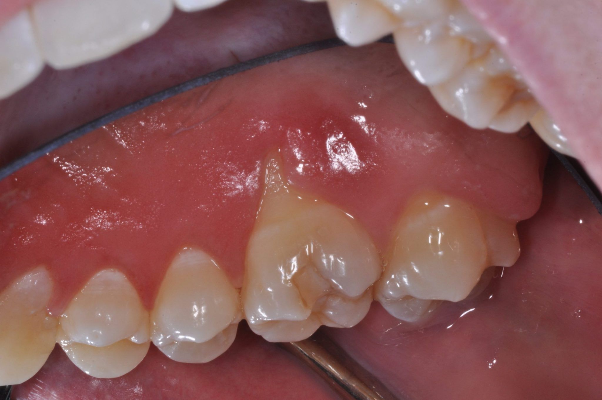 Gingival (Gum) Grafting – Dental Implants & Periodontics of CT