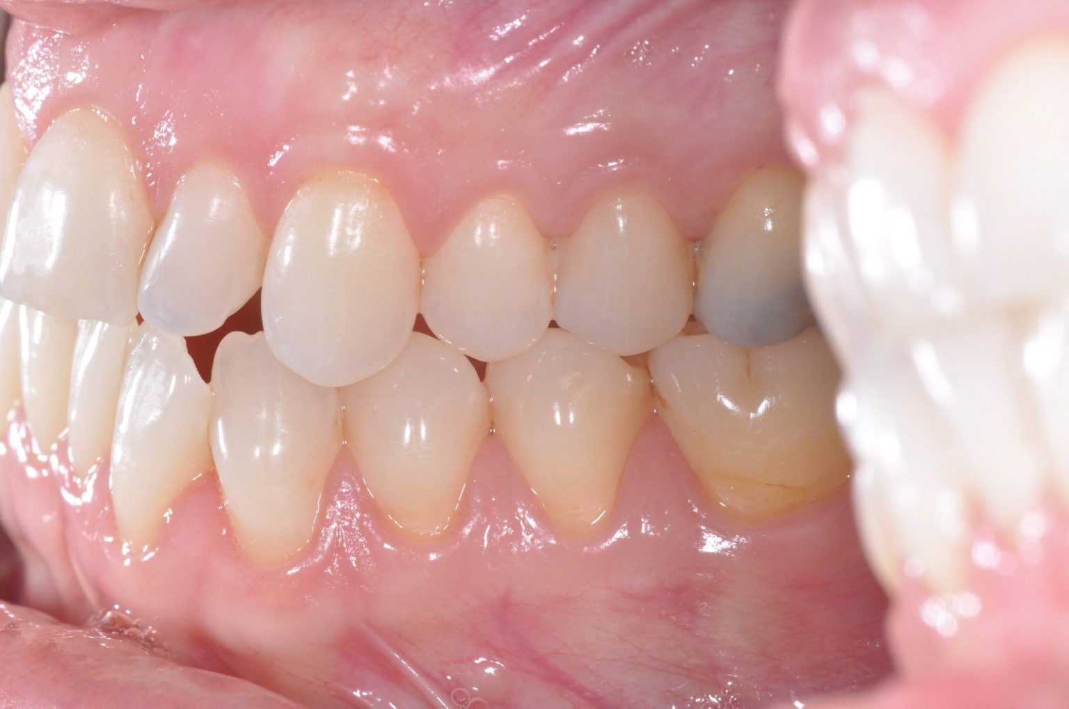 Gingival (Gum) Grafting – Dental Implants & Periodontics of CT