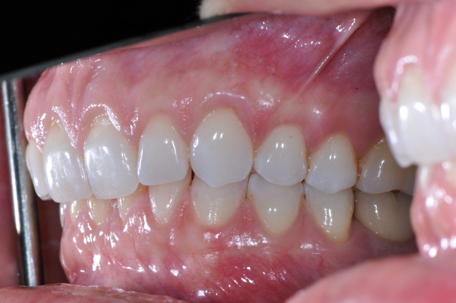 Gingival (Gum) Grafting – Dental Implants & Periodontics of CT