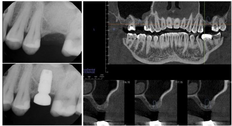 Sinus Elevation/Lift – Dental Implants & Periodontics of CT
